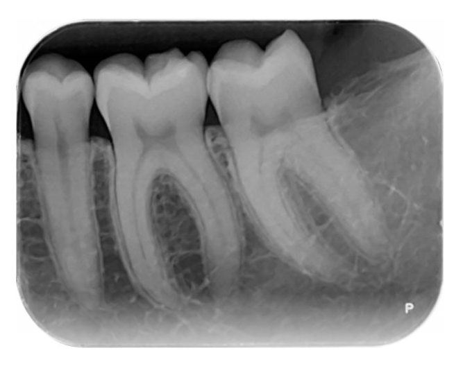 Acteon Pspix 2 - Réalisation technique dentaire